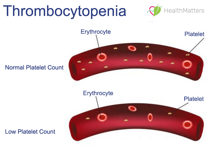 What is Thrombocytopenia? (low platelet count) + Causes / Symptoms