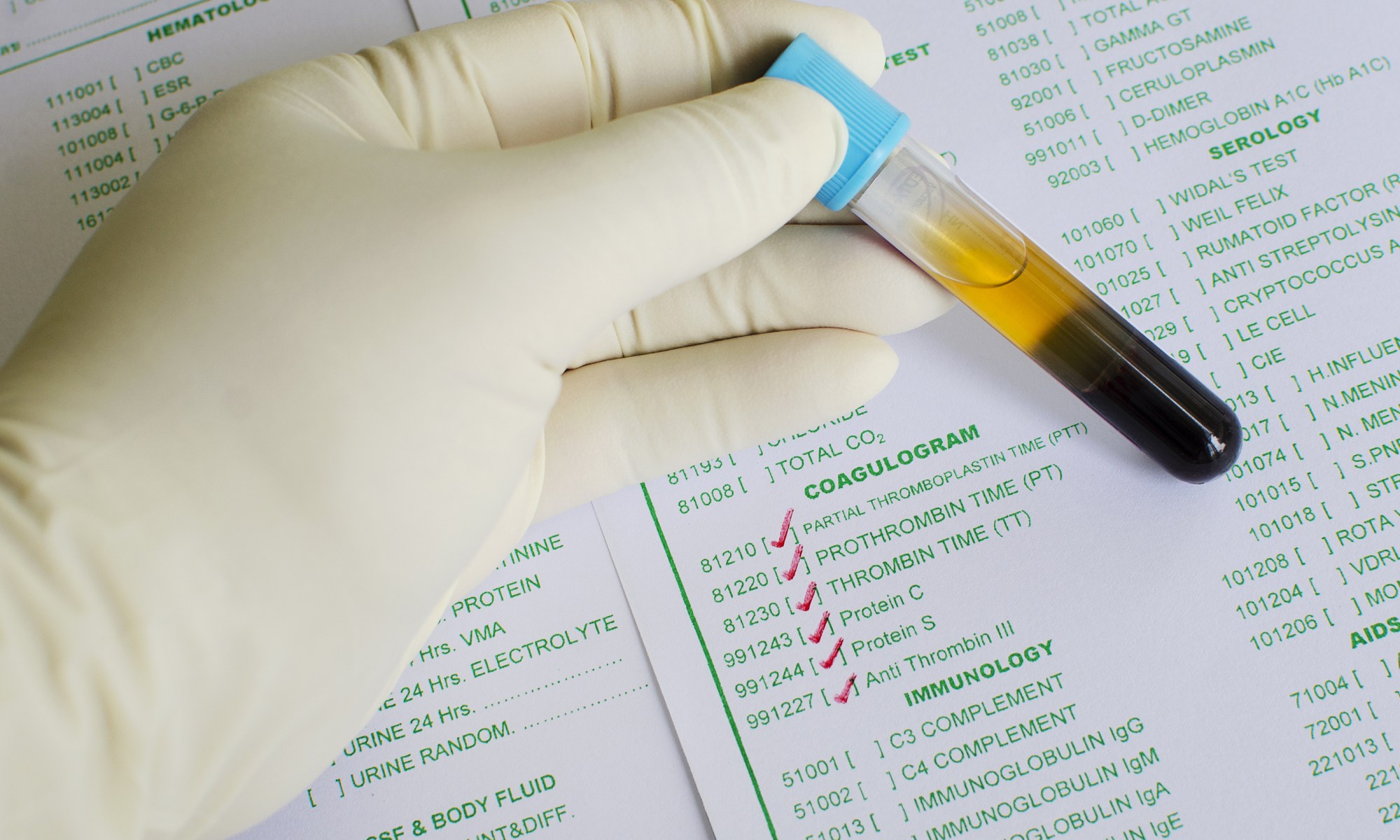 Activated partial thromboplastin time (APTT) test | Definitions+Normal ...