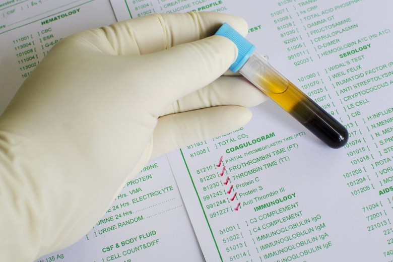 Activated partial thromboplastin time (APTT) test | Definitions+Normal ...