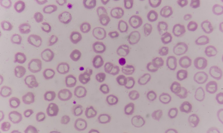 What does it mean if Plateletcrit value is high?