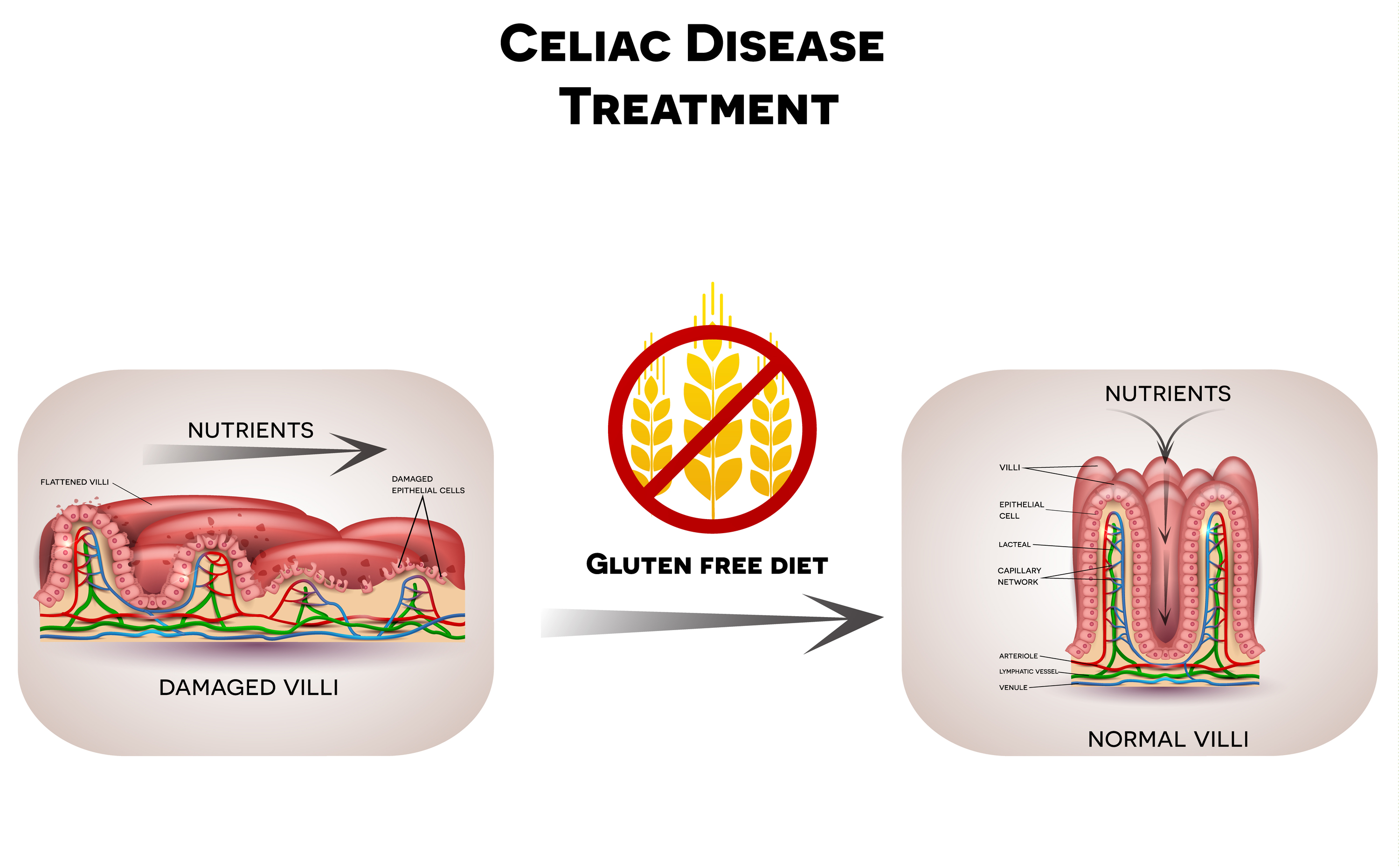 What is t-Transglutaminase (tTG)?