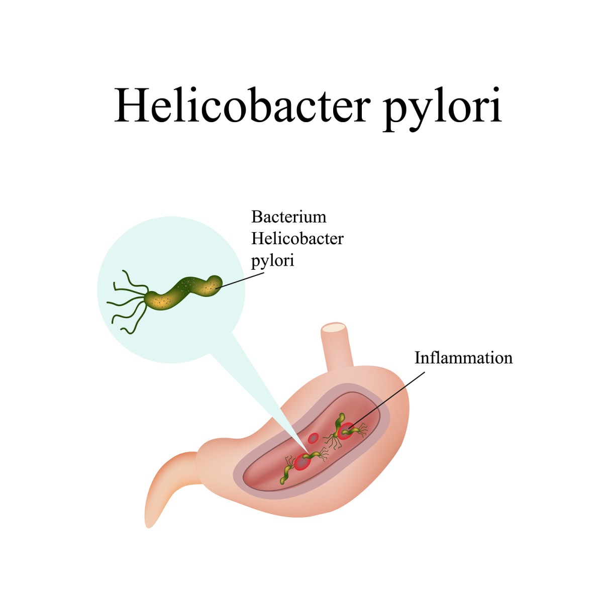 What is the H. pylori Breath Test?